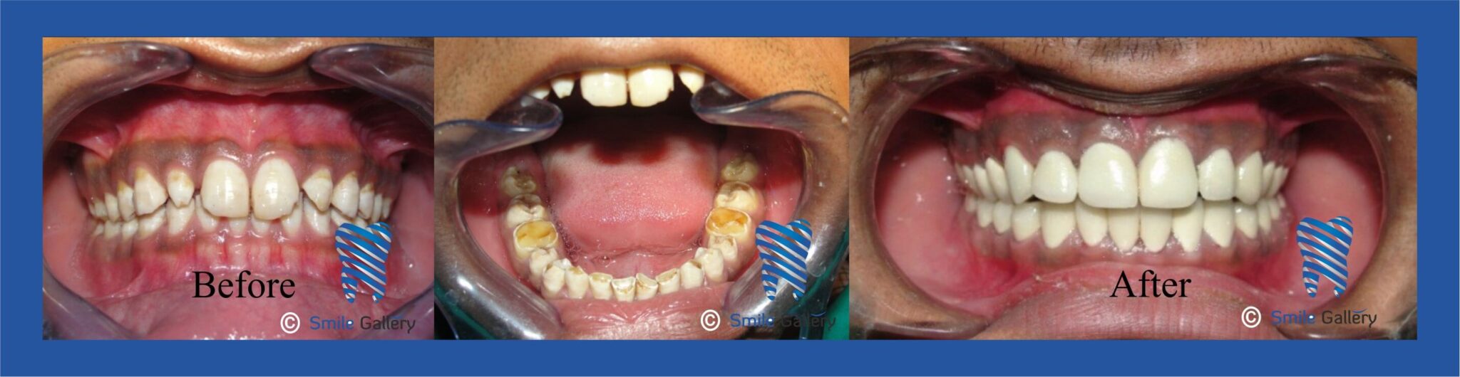 Full Mouth Rehabilitation Treatment in Arera Colony Bhopal